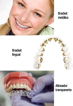 | Tipos de brackets